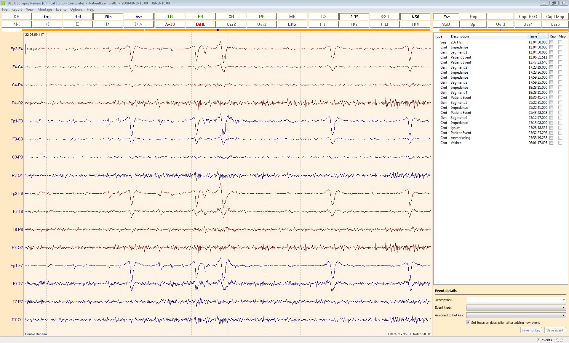 BESA® | Brain Electrical Source Analysis: Features > EEG review BESA® | Brain Electrical Source Analysis: Features > EEG review