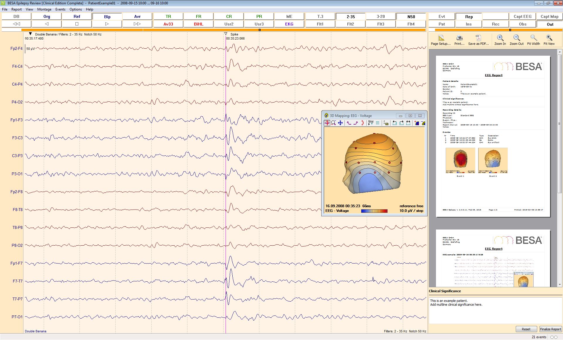 BESA® | Brain Electrical Source Analysis: Features > EEG review BESA® | Brain Electrical Source Analysis: Features > EEG review