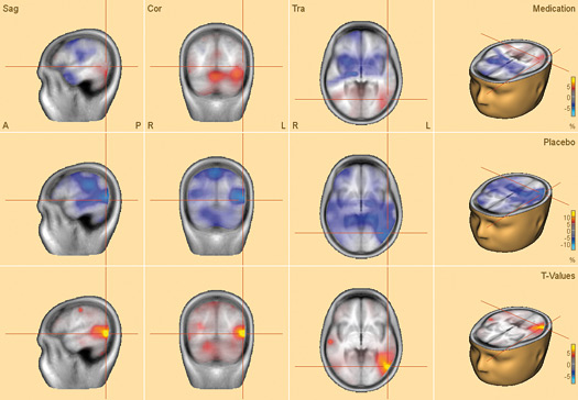 Besa® Brain Electrical Source Analysis Features Permutation Testing