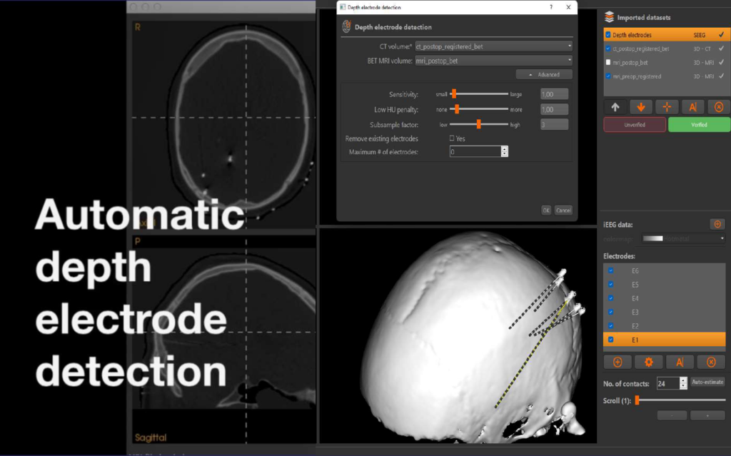 The BESA universe gets DENSer: depth electrode detection with DENS